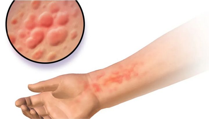 Can You Be Allergic To Water Aquagenic Urticaria Techietonics